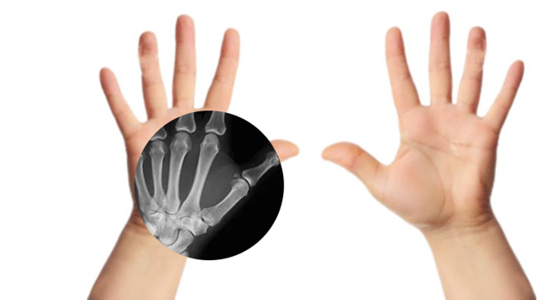 Simular visión de Rayos X, nivel básico